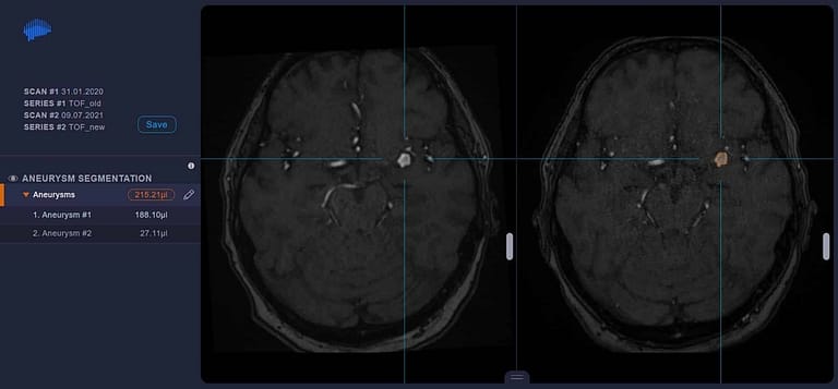 Detection Of Aneurysms